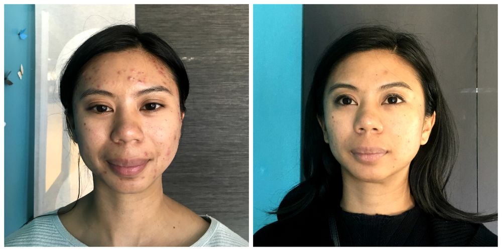 Micro-needling for Acne