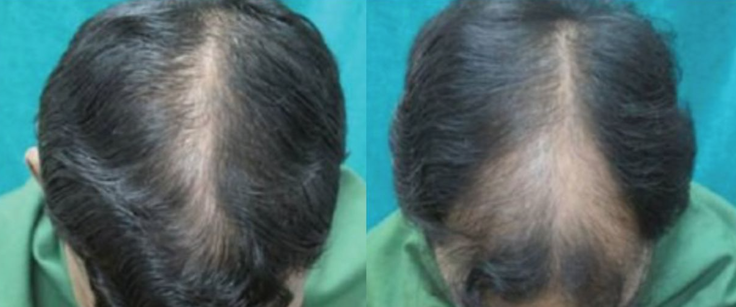 Needling For Hair Growth